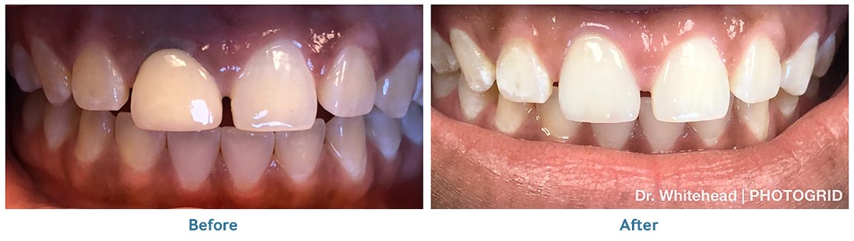 Smile Gallery | Altamonte Springs, Florida | Palm Springs Dental